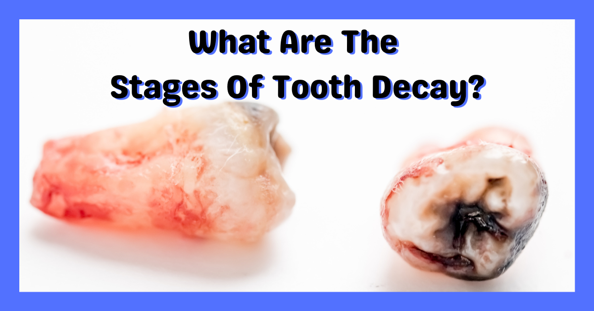 What Are The Stages Of Tooth Decay? | Dental Insurance Insiders
