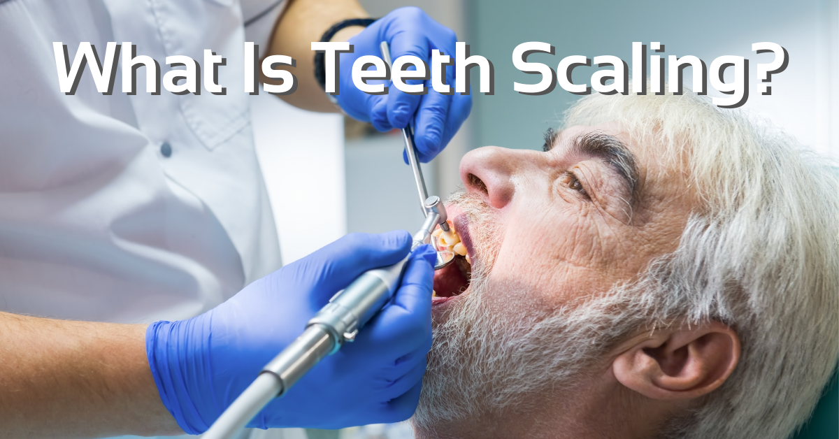 What Is Teeth Scaling? | Dental Insurance Insiders