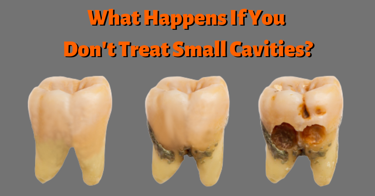 What Happens If You Don't Treat Small Cavities? | Dental Insurance Insiders
